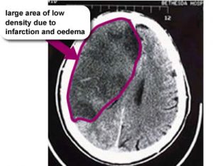 The presenting features of a patient with TACS - CHSS eLearning
