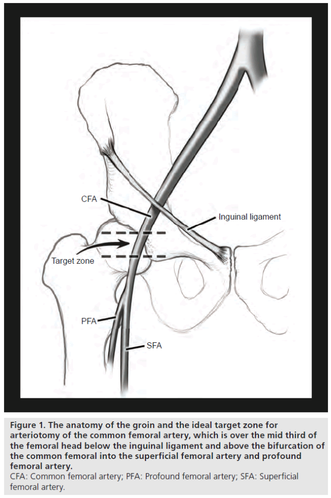 Inguinal Ligament Anatomy Muscles Of The Groin