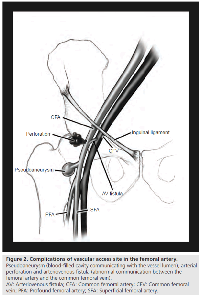 Management of the puncture site (most often in the groin) - CHSS eLearning