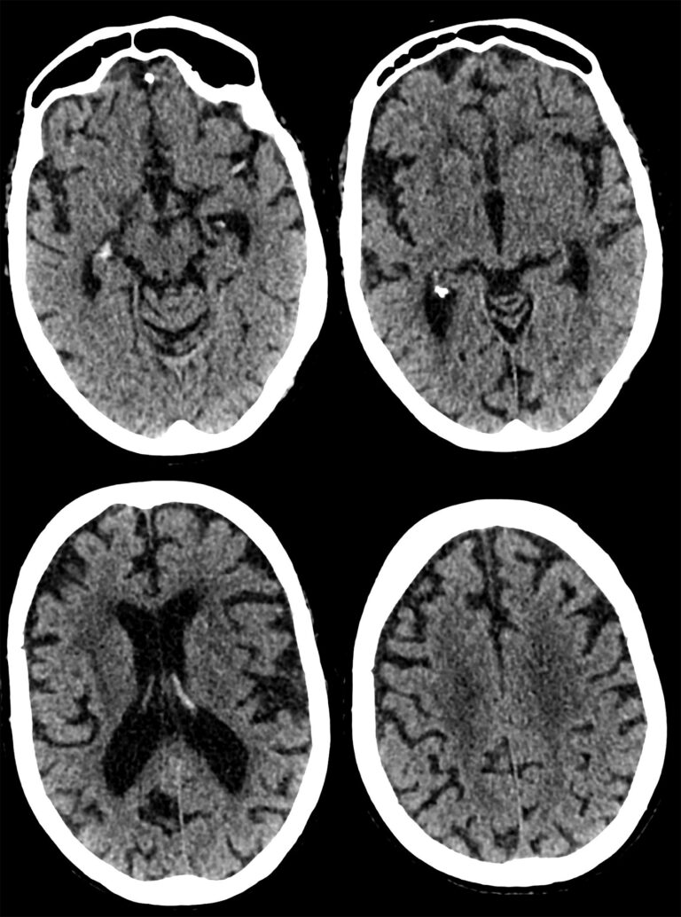 01: Non contrast CT head - CHSS eLearning