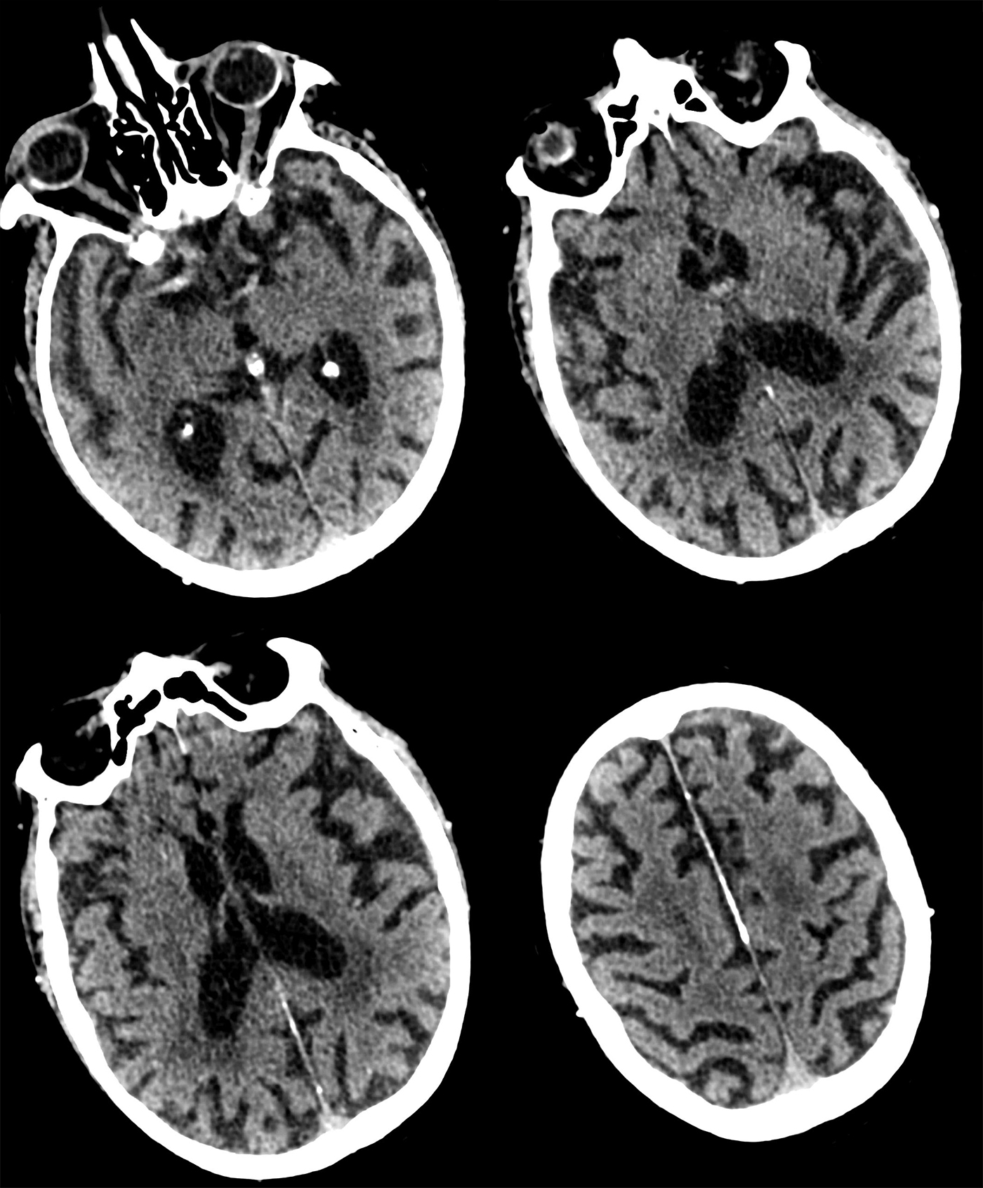 02: Non contrast CT head - CHSS eLearning