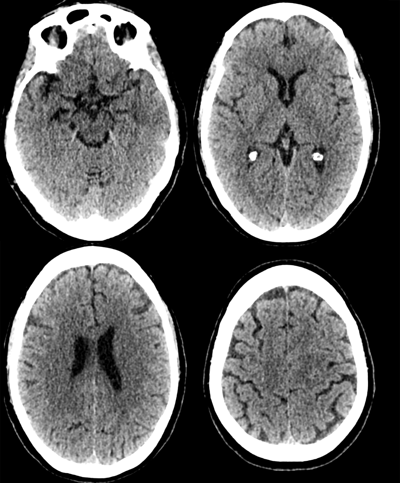 17: Non contrast CT head - CHSS eLearning
